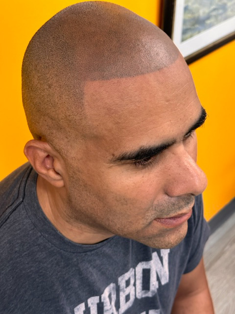 Silver Spring, MD Scalp Scar Camouflage | SMP Virtuosos