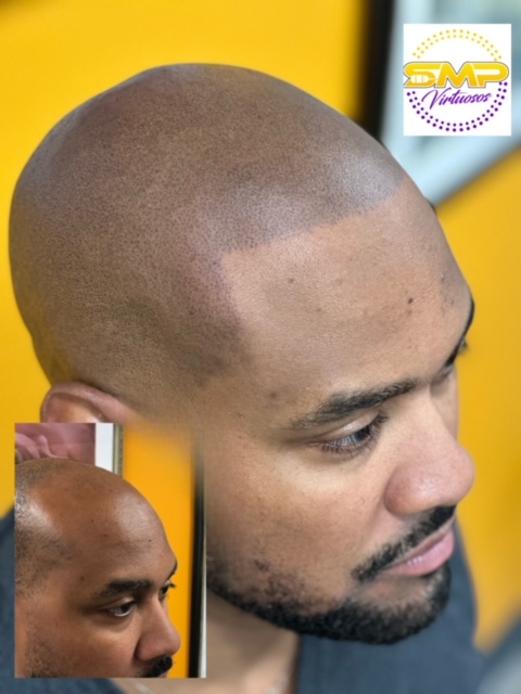 Scalp Micropigmentation Gallery | SMP Virtuosos